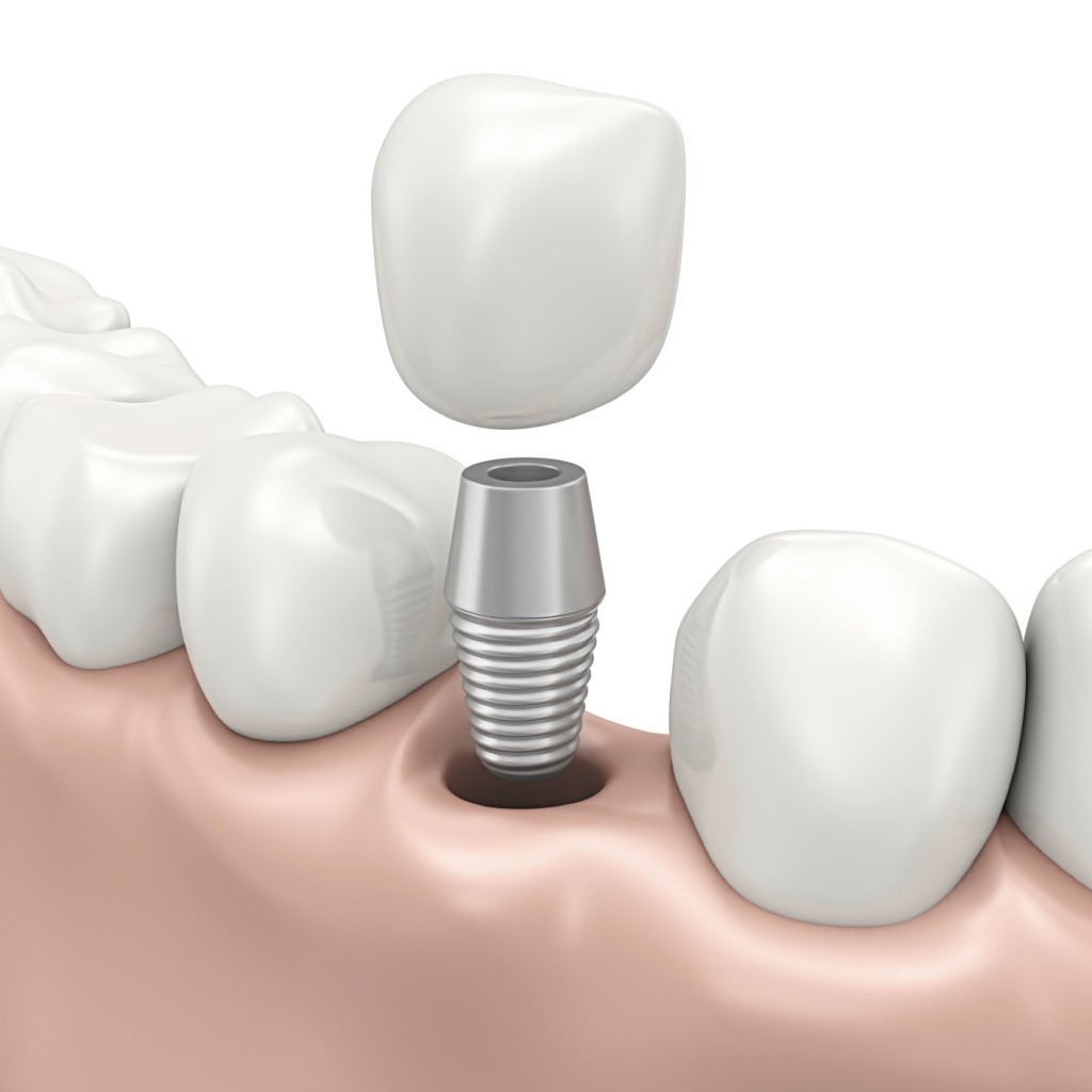 Dental Implants Park Ridge | Loukas Dentistry of Park Ridge